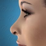 Correction of hanging columella by rhinoplasty - symptoms and causes